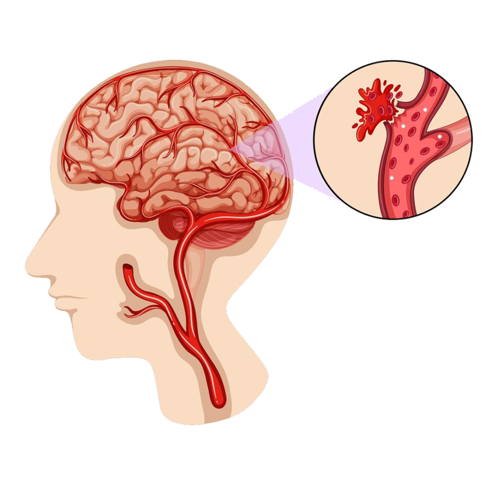 Hemophilia Awareness: 10 Facts You Should Know About This Bleeding ...